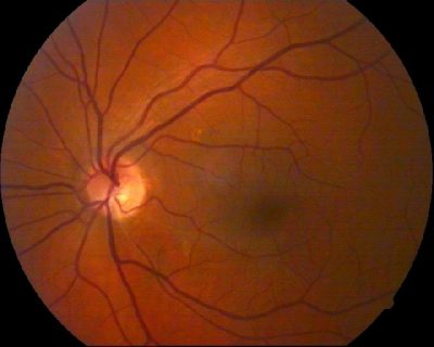 ¿Qué es una trombosis ocular? Síntomas, causas y tratamiento