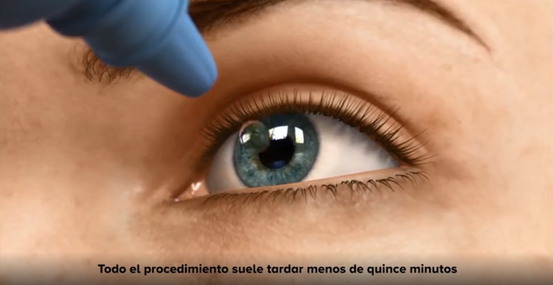 ¿Qué son las lentes ICL? Tratamiento para la Alta Miopía
